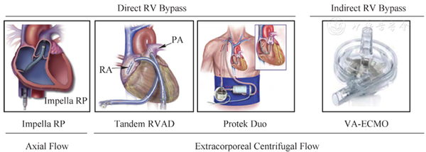 终末期心力衰竭机械循环支持的国内外器械梳理 - 知乎