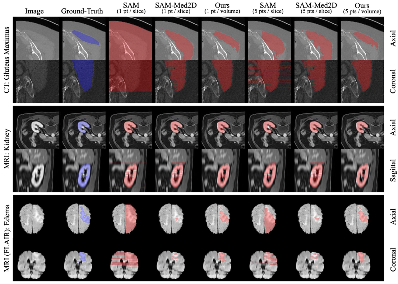 SAM-Med3D：三维医学图像上的通用分割模型，医疗版三维 SAM 开源了！ - 知乎
