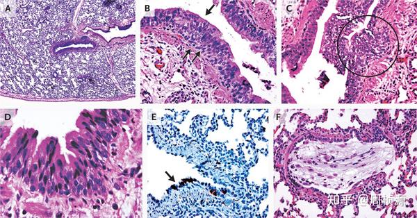 Nejm 2011 Case 37 - 知乎