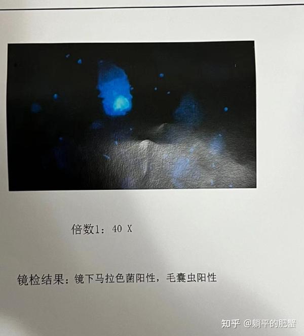 为什么黑头的总是反反复复去不干净?如何有效去黑头? 知乎