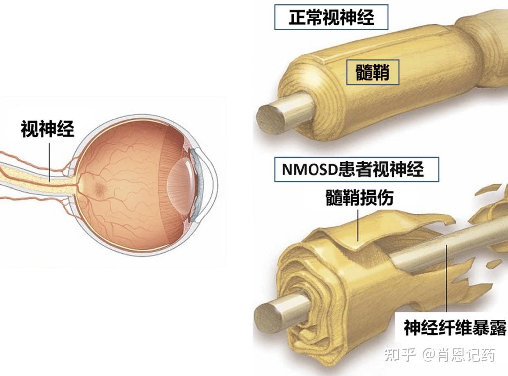 记住所有FDA生物药 | 抗CD19 | 治疗视神经脊髓炎谱系疾病NMOSD | 昕越®伊奈利珠单抗 - 知乎