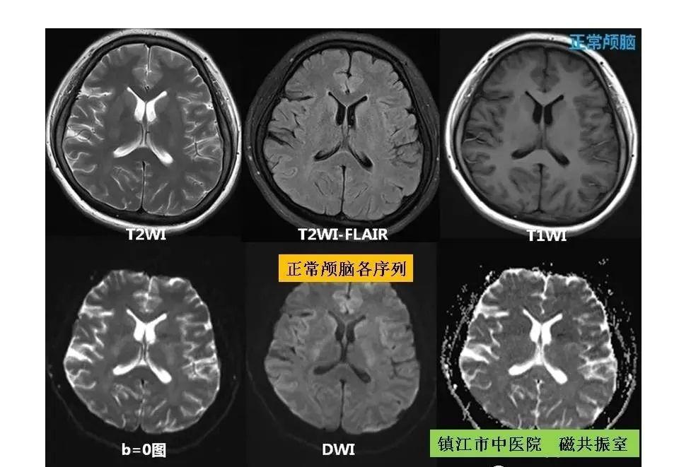 神内临床笔记56 正常颅脑MRI表现 - 知乎