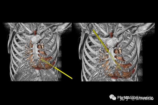3mensio Aortic - 知乎