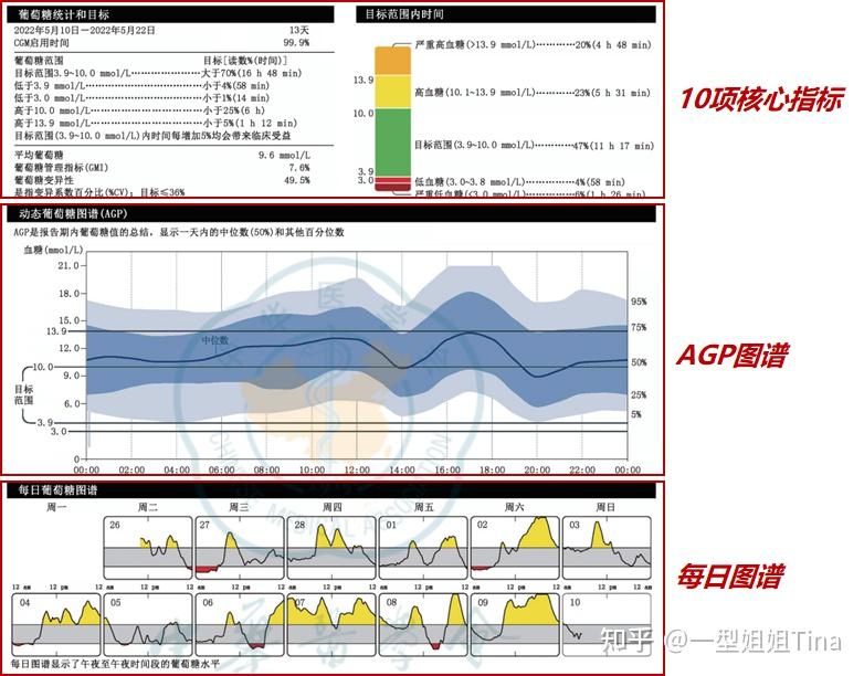 干货!三个模块带你全方位阅读一份动态血糖CGM/AGP报告 - 知乎