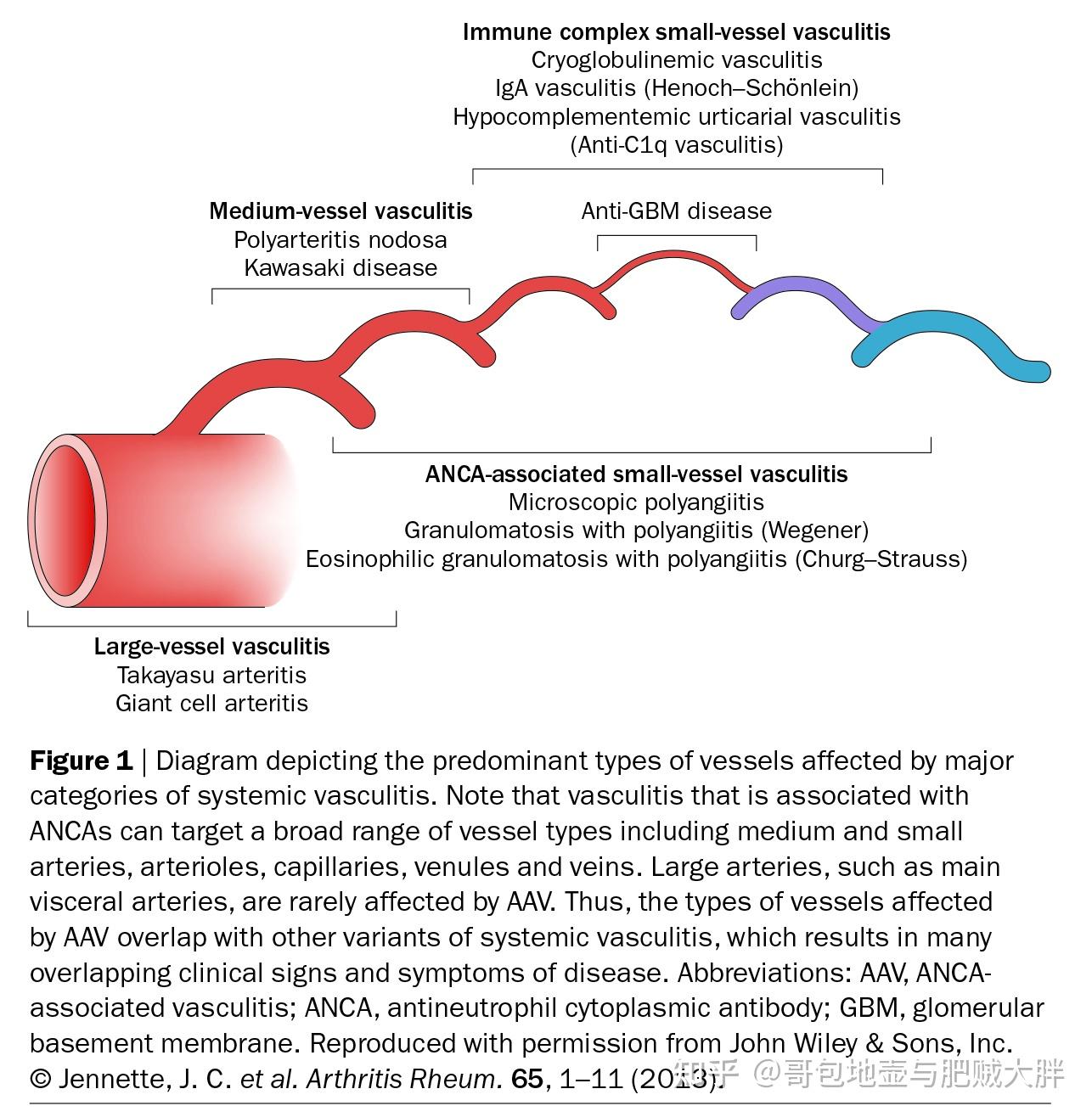 关于ANCA你能了解多少：第一话 - 知乎