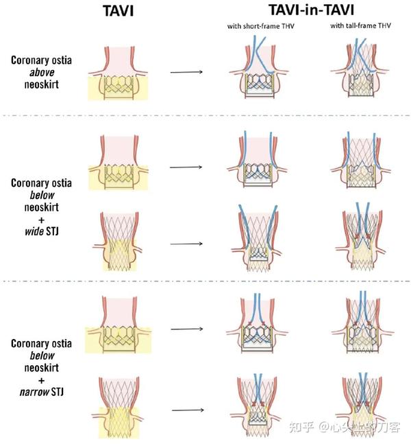 TAVR患者的冠状动脉疾病管理（三）之瓣膜植入后的冠脉通路 - 知乎