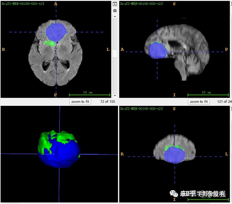 BraTS2023-MEN——BraTS2023颅内脑膜瘤分割挑战赛 - 知乎