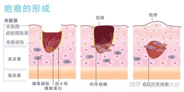 SRT-100浅放治疗烫伤疤痕，看这篇就够了！ - 知乎