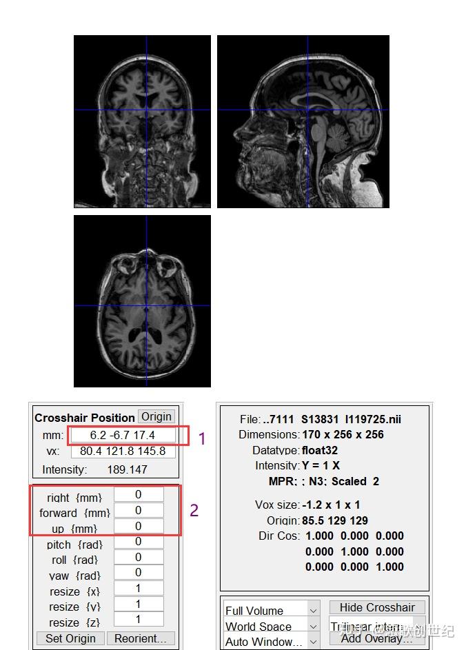 基于SPM的磁共振图像(MRI)手动ACPC矫正 - 知乎