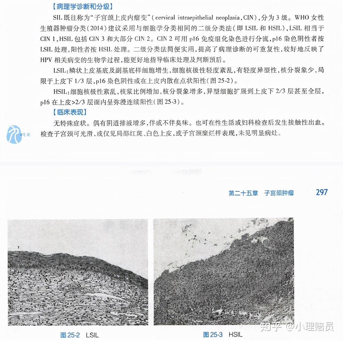 浅谈宫颈上皮内瘤变(cin)与原位癌理赔 知乎