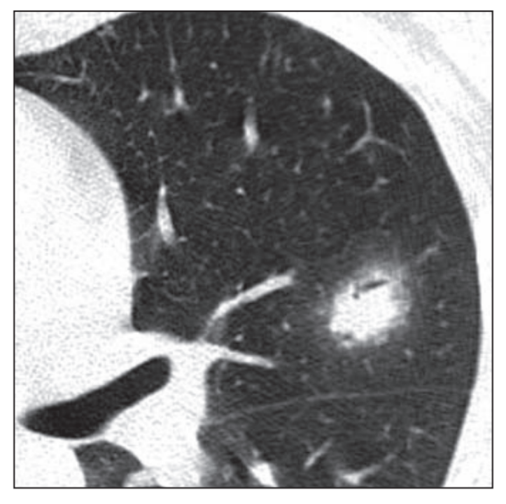 肺结节鉴别诊断-具有病理结果的CT案例 - 知乎