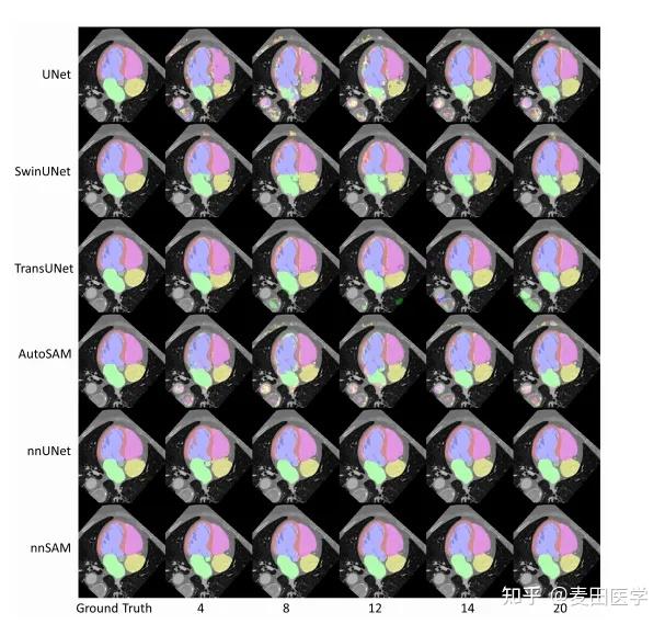 文献速递：基于SAM的医学图像分割---nnSAM：即插即用的分割任何东西模型 模型提升了nnUNet性能 - 知乎