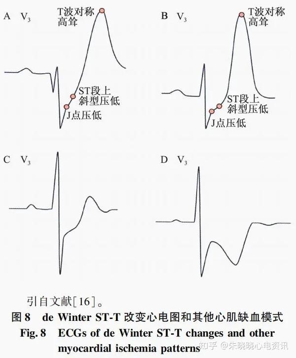 对心电图de Winter ST-T改变的思考 - 知乎