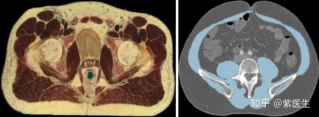 定量CT（QCT）是什么？临床应用有哪些？ - 知乎
