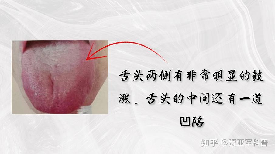 肝不好，病来找，肝郁怎么参考中成药？医生通过舌象告诉你答案 知乎