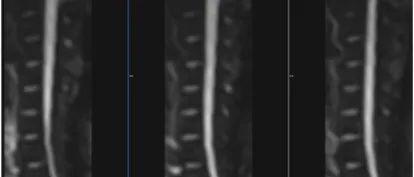 IRIS：多激发SE-EPI扩散（弥散）序列 - 知乎