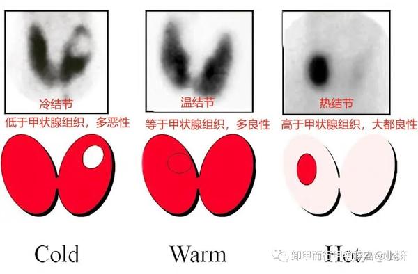 7-36：ECT、PET-CT显像下甲状腺“热、温、凉、冷”结节与甲状腺癌关系 - 知乎