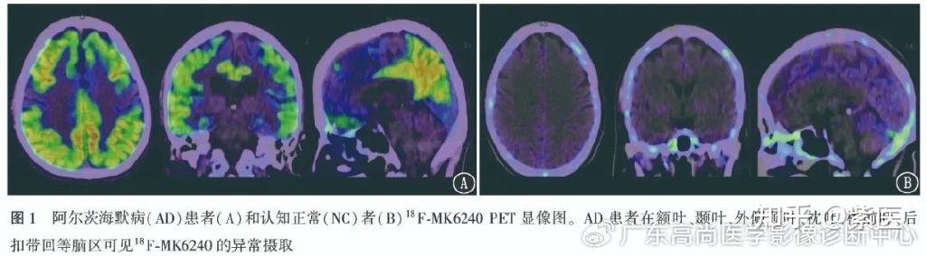 阿尔茨海默病中tau蛋白的18F-MK6240 PET显像研究及认知相关分析 - 知乎