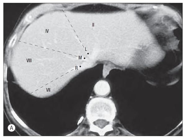 肝脏的分叶与分段 - 知乎