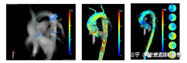 4D-Flow扫描数据采集：序列及参数 - 知乎