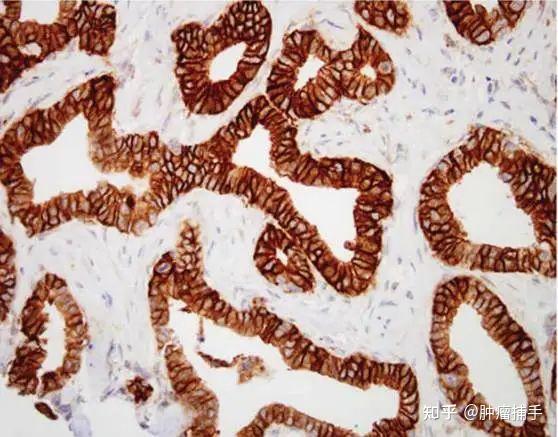 CLDN18.2的前世今生（3）-CLDN18.2药物横空出世 - 知乎