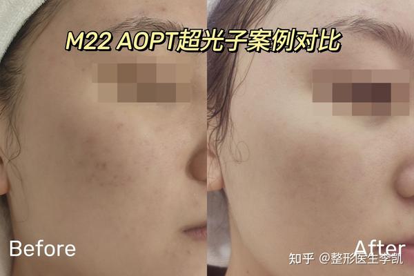 M22 AOPT超光子：到底什么是AOPT超光子？ - 知乎
