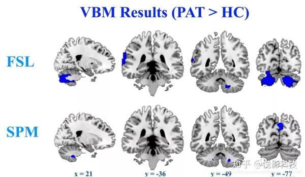 不同的工具包对Voxel-based morphometry (VBM)计算结果的影响 - 知乎