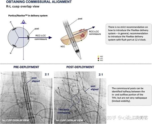 连合对齐（Commissural Alignment）：原理、定义、技术和结果（中） - 知乎