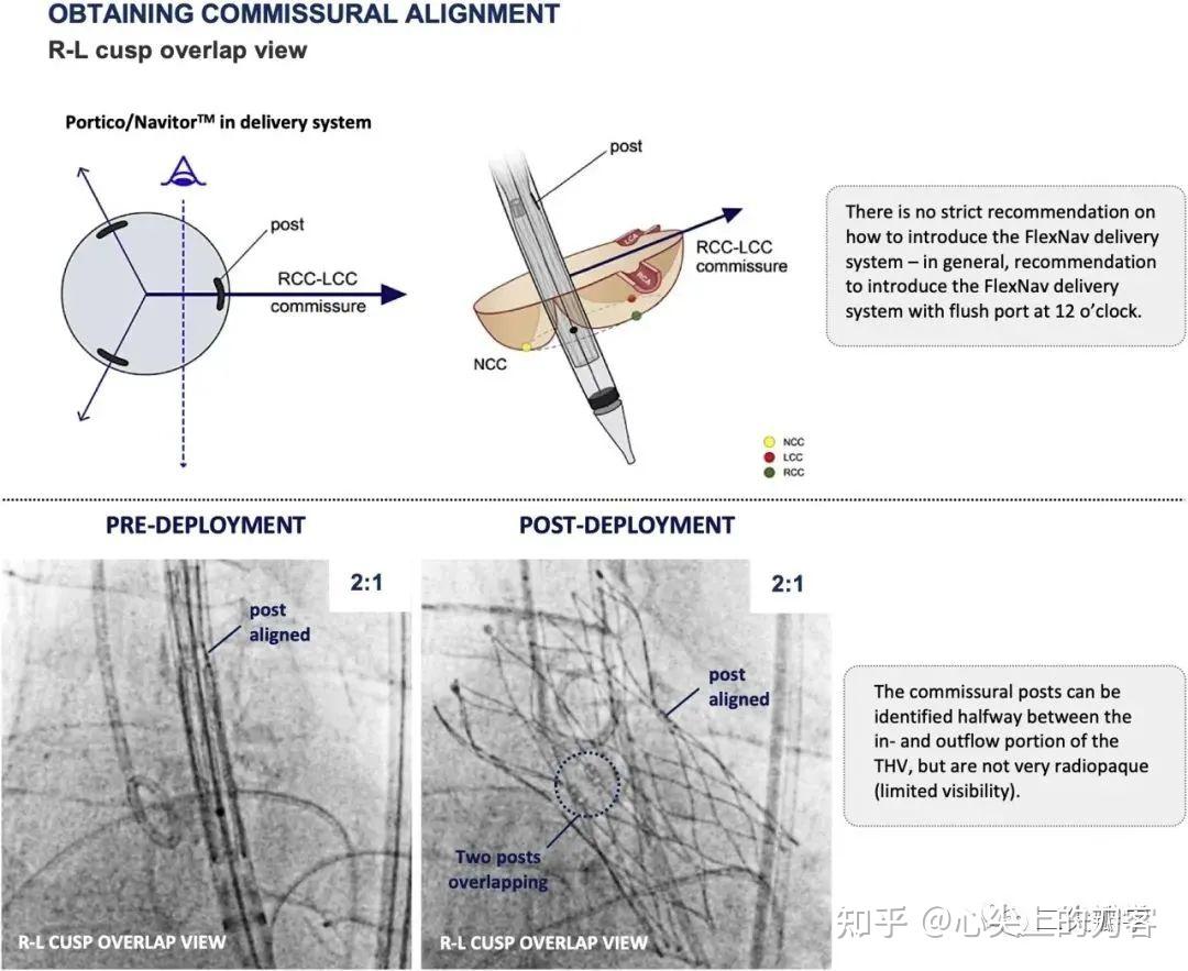 连合对齐（Commissural Alignment）：原理、定义、技术和结果（中） - 知乎