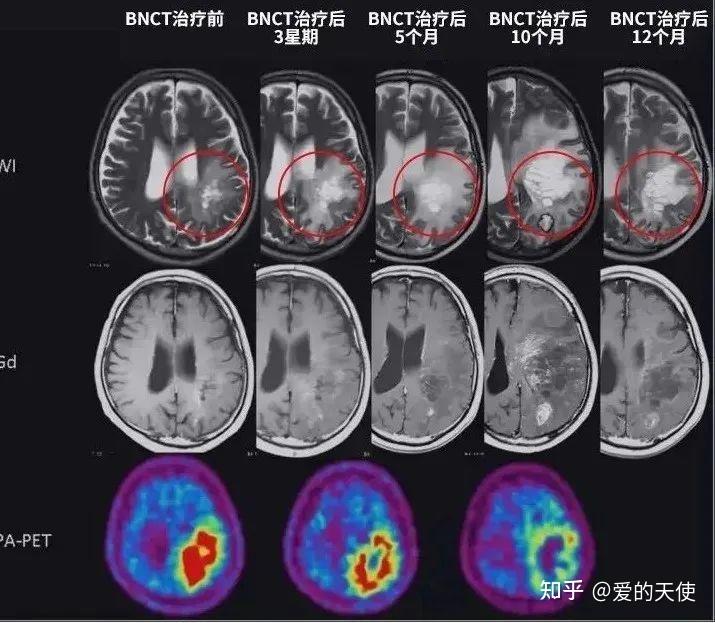 揭秘！火遍全网的（BNCT）硼中子俘获疗法国内真的开始接收患者了吗？ - 知乎