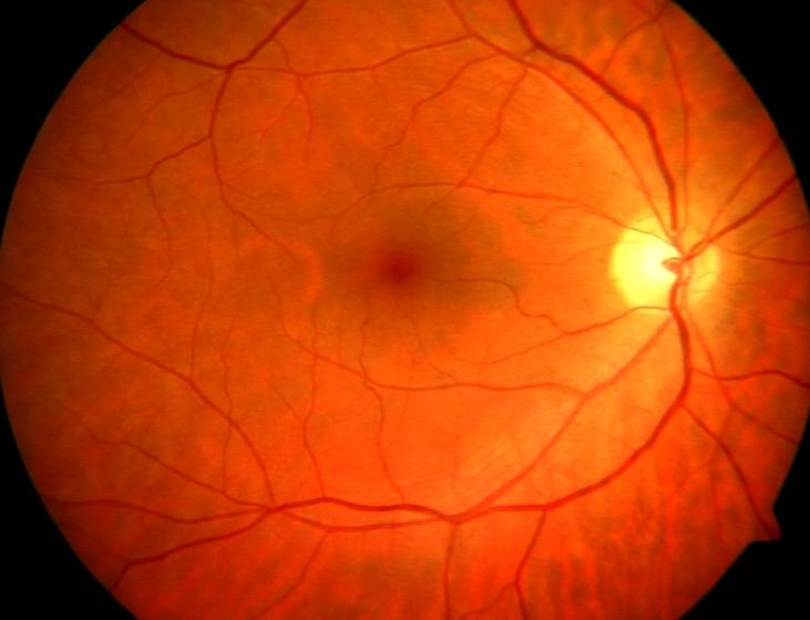 Multi-Label Retinal Diseases视网膜眼底图像分类数据集介绍 - 知乎