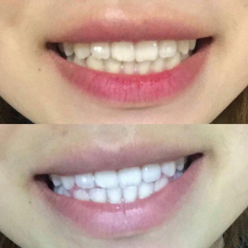 牙黄怎么办？尝试过很多办法？ - 知乎