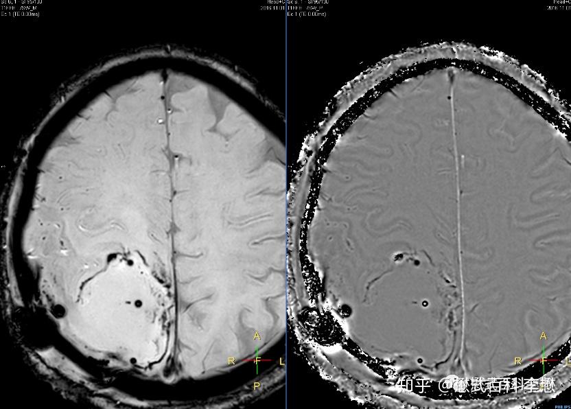 SWI序列原理及临床应用 - 知乎