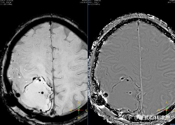 SWI序列原理及临床应用 - 知乎
