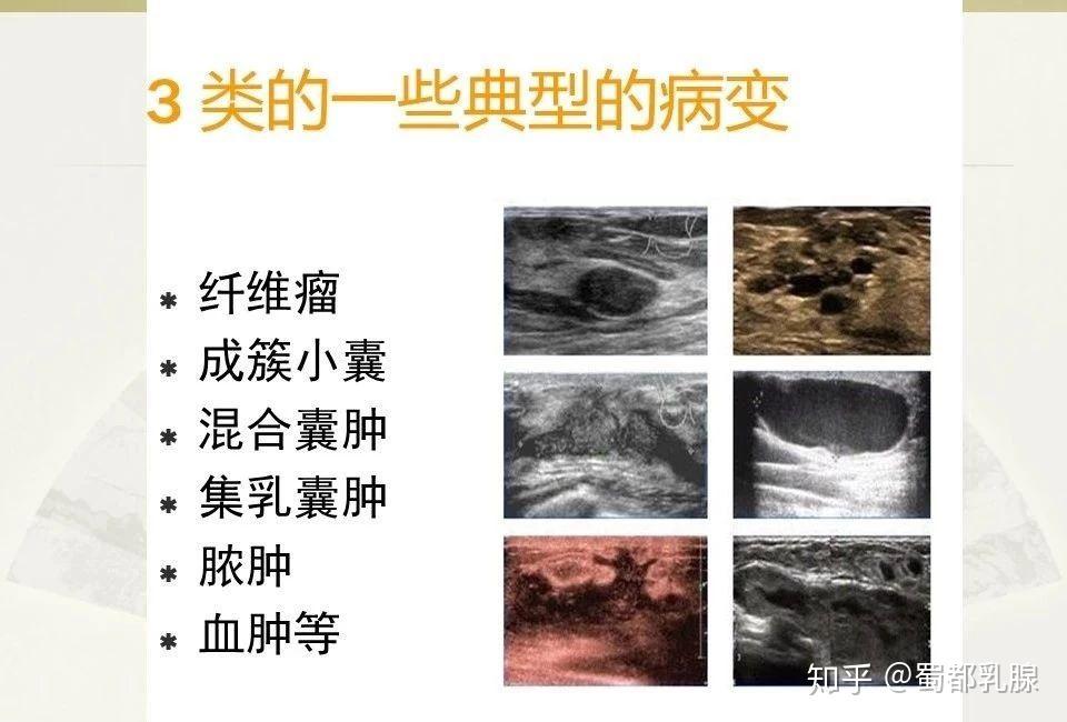 关于乳腺超声bi Rads分级，最全的解读来啦！ 知乎
