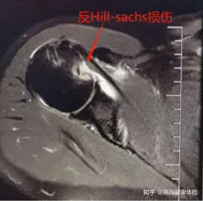 肩关节Hill-Sachs并Bankart损伤 - 知乎