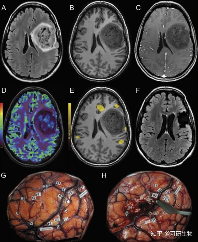 不做实验也可以发文章:MRI数据分析 - 知乎
