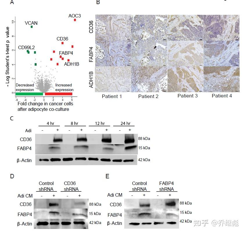 脂肪细胞通过诱导FABP4表达促进卵巢癌细胞迁移和介导对卡铂耐药 - 知乎