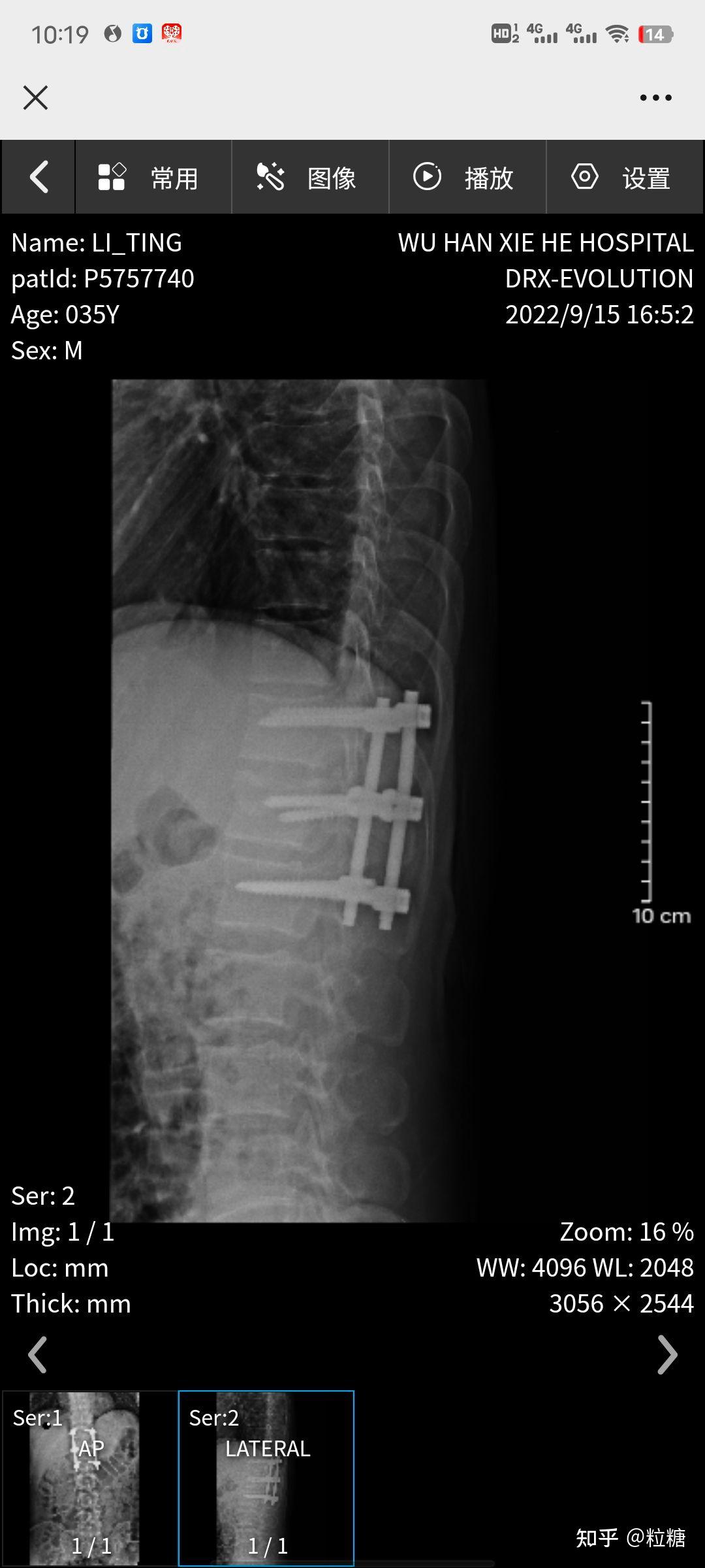 胸椎T12压缩性骨折治疗康复过程（持续更新） - 知乎