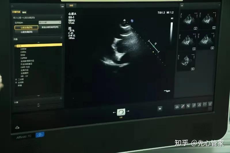 呼伦贝尔市首例MemoSorb®(生物可降解卵圆孔未闭封堵器)植入术在扎兰屯市中蒙医院完成 - 知乎