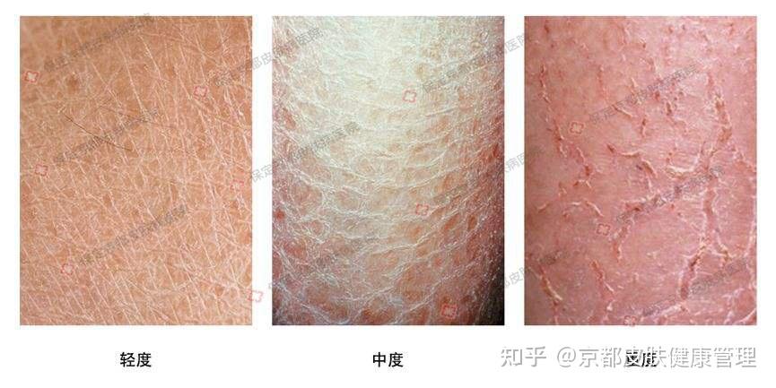 干性湿疹是怎么回事？你了解多少？日常要注意哪些？ 知乎