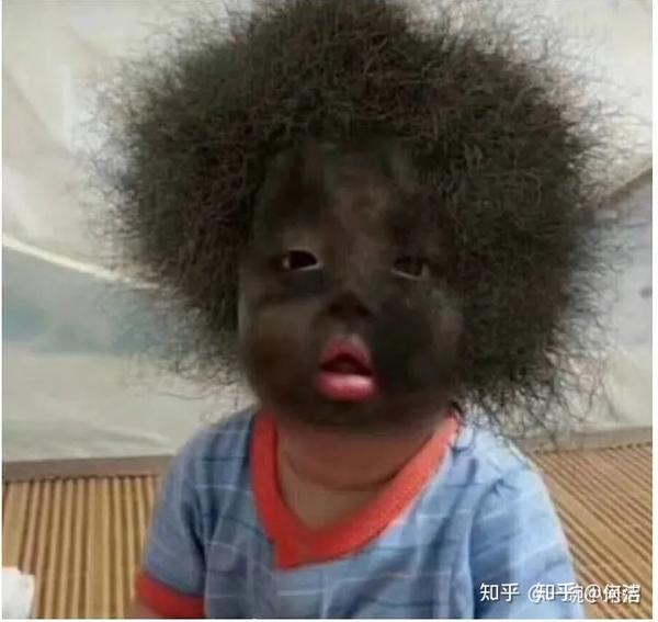 红色痘痘痘印反反复复长了好久 初中到现在终于好点了 知乎