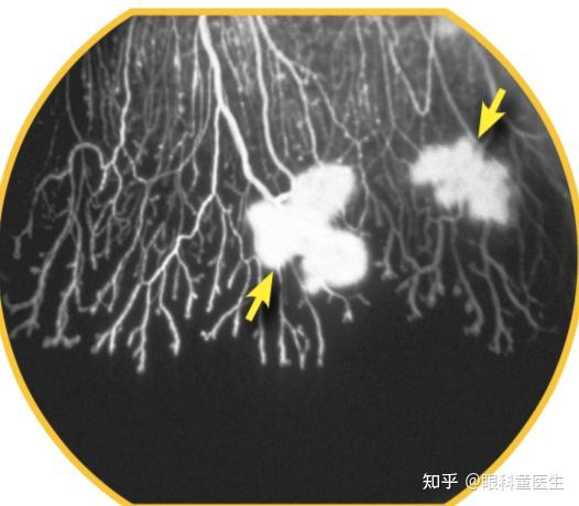 视网膜血管性疾病——4、家族性渗出性玻璃体视网膜病变 - 知乎