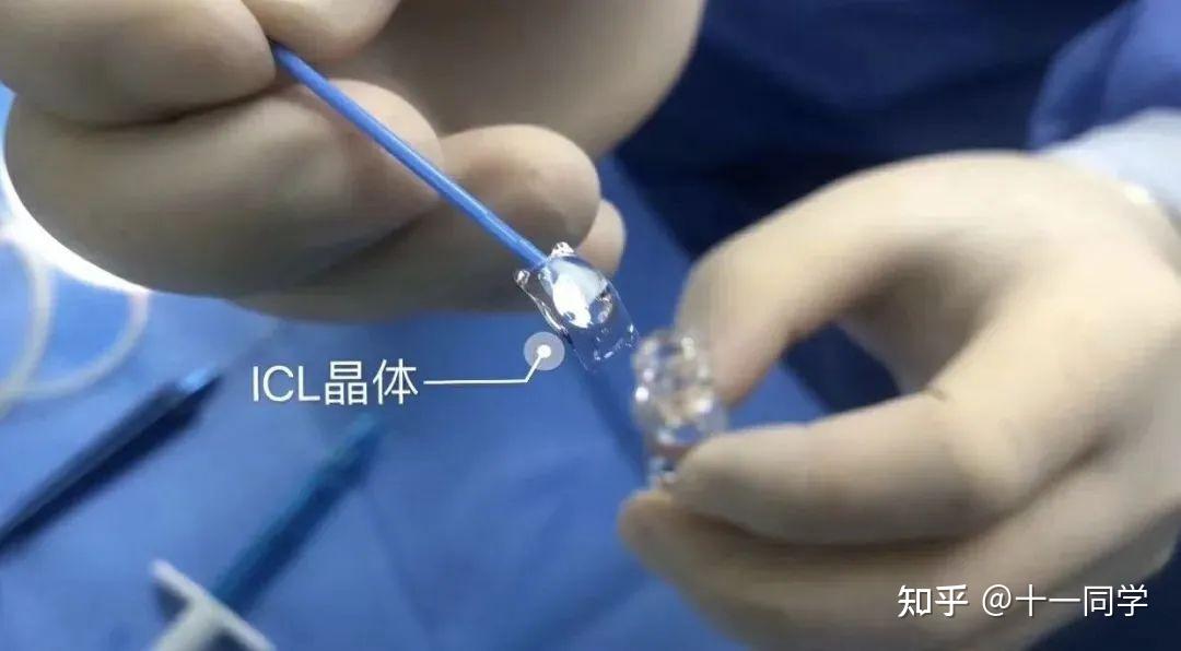 ICL晶体植入为什么比激光手术贵？ - 知乎