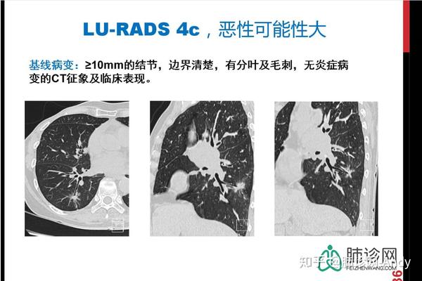 刘士远教授——肺结节lung-RADs报告分级系统解读 - 知乎