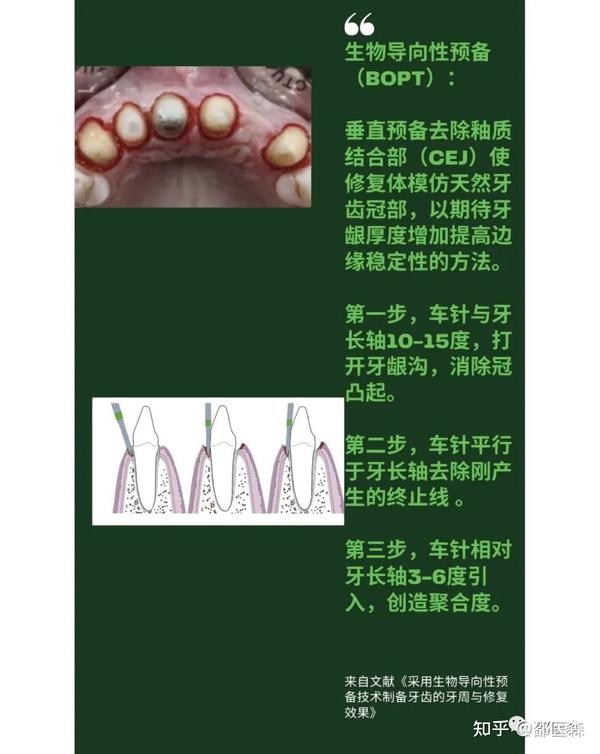 美学新花招：BOPT牙体预备 - 知乎