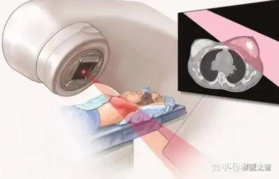 肿瘤放射治疗中的“利器”——直线加速器 知乎 3111