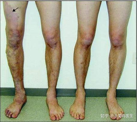 KTS---静脉畸骨肥大综合征(Klippel-Trenaunay syndrome) - 知乎