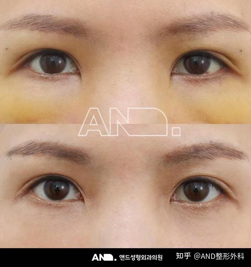 凹陷的眼睛打造自然童颜双眼皮的方法眼上脂肪移植眼底脂肪调整前后事例 知乎