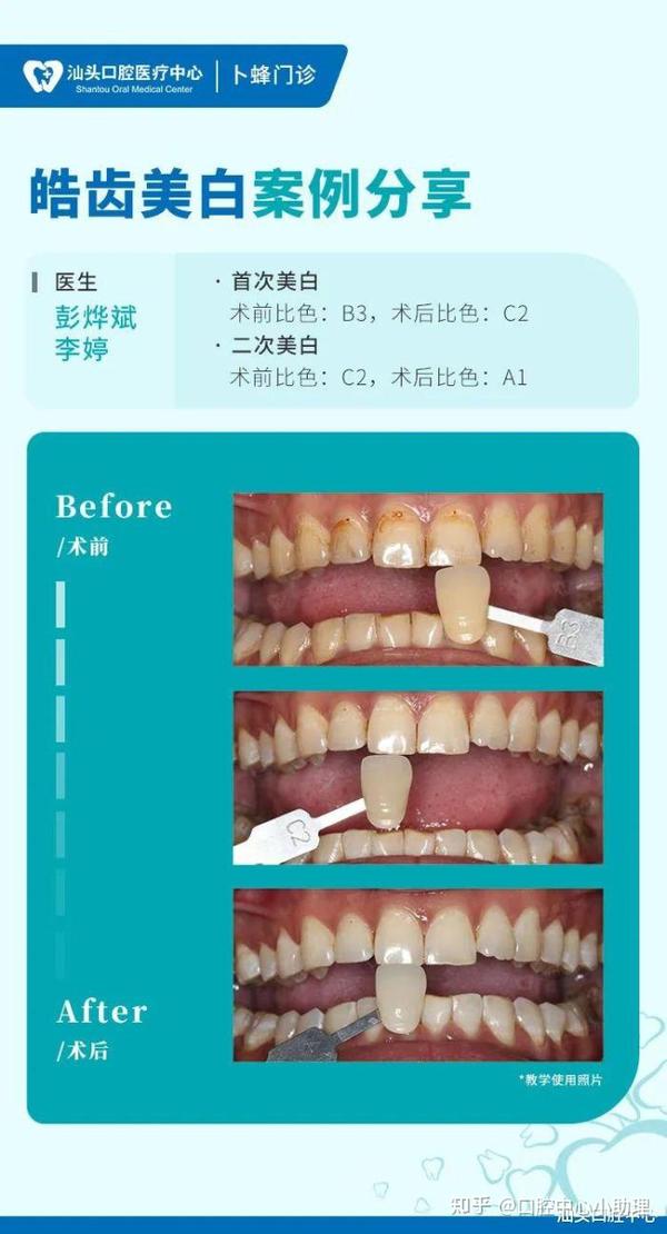 吸烟喝茶导致牙齿变黄,该怎么办? 知乎